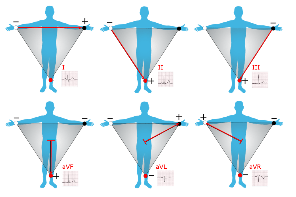 ECG Limb Lead Reversal LITFL ECG Library Diagnosis