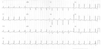 Lown–Ganong–Levine syndrome • LITFL • Medical Eponym Library