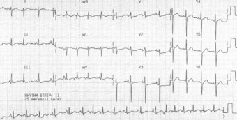 ECG in Chronic Obstructive Pulmonary Disease • LITFL • ECG Library