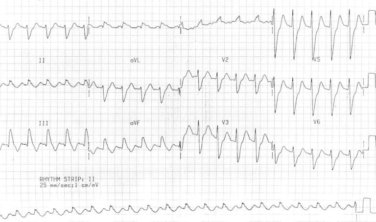 ECG changes in Pulmonary Embolism • LITFL • ECG Library