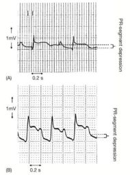 PR segment • LITFL • ECG Library Basics
