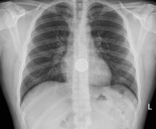 Top 10 X-Ray Foreign Bodies • LITFL • Arcanum veritas