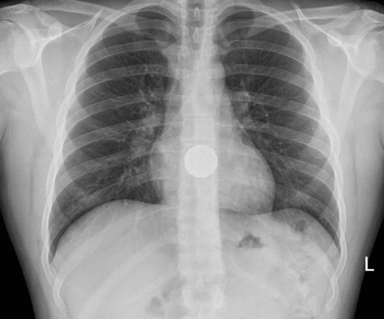 Top 10 X-Ray Foreign Bodies • LITFL • Arcanum veritas