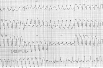 Ventricular Tachycardia – Monomorphic VT • LITFL • ECG Library