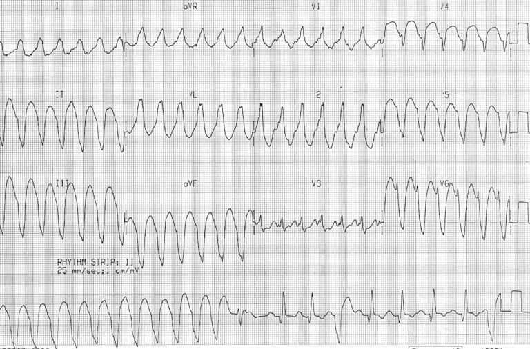 Ventricular Tachycardia – Monomorphic VT • LITFL • ECG Library