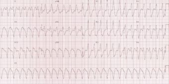 Ventricular Tachycardia – Monomorphic VT • LITFL • ECG Library
