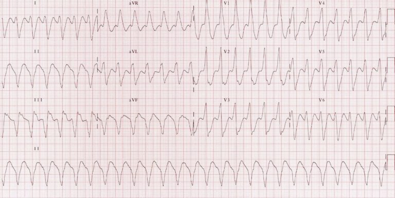 Ventricular Tachycardia – Monomorphic VT • LITFL • ECG Library