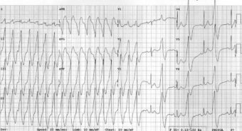 Ventricular Tachycardia – Monomorphic VT • LITFL • ECG Library