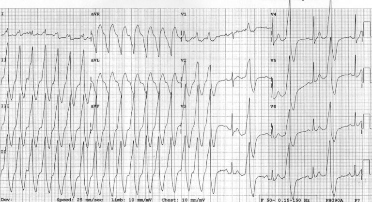 Ventricular Tachycardia – Monomorphic VT • LITFL • ECG Library