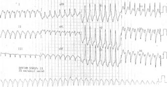 Ventricular Tachycardia – Monomorphic VT • LITFL • ECG Library