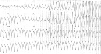 Ventricular Tachycardia – Monomorphic VT • LITFL • ECG Library