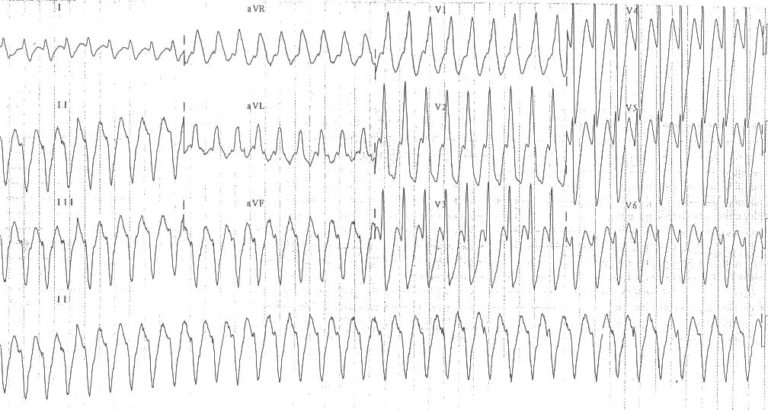 Ventricular Tachycardia – Monomorphic VT • LITFL • ECG Library