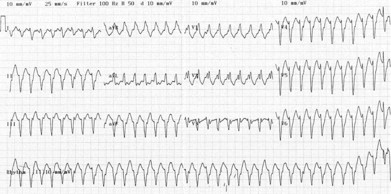 Ventricular Tachycardia – Monomorphic VT • LITFL • ECG Library