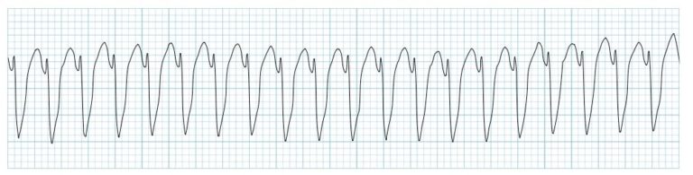 Ventricular Tachycardia – Monomorphic VT • LITFL • ECG Library
