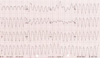 Ventricular Tachycardia – Monomorphic VT • LITFL • ECG Library