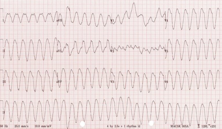 Ventricular Tachycardia – Monomorphic VT • LITFL • ECG Library
