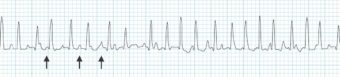 Multifocal Atrial Tachycardia (MAT) • LITFL • ECG Library Diagnosis