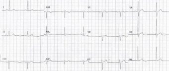 U Wave • LITFL Medical Blog • ECG Library Basics