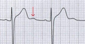 Paediatric ECG: Stepwise approach • LITFL • ECG Library Diagnosis