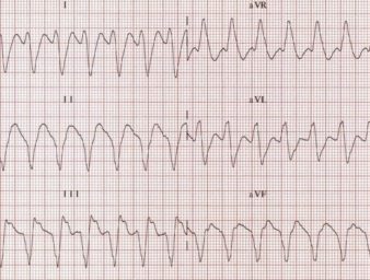 ECG Axis Interpretation • LITFL • ECG Library Basics