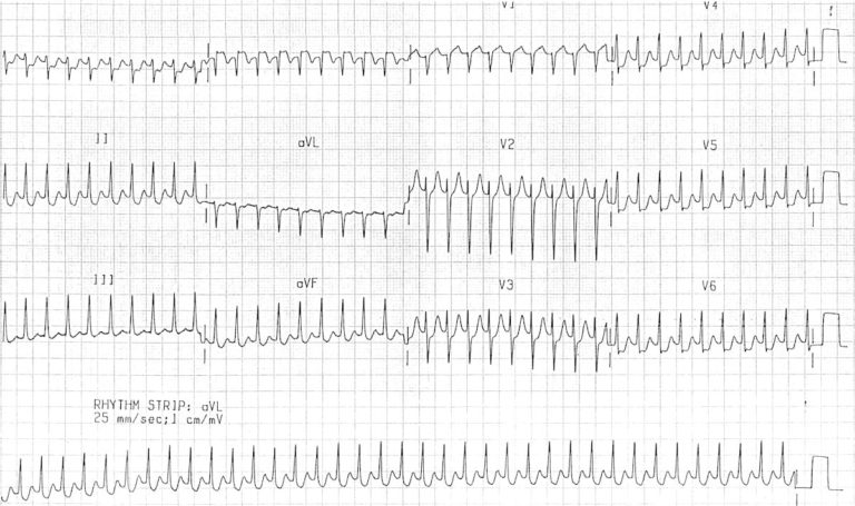 Atrioventricular Re-entry Tachycardia (AVRT) • LITFL • ECG Library ...