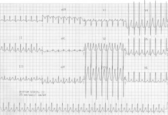 Atrioventricular Re-entry Tachycardia (AVRT) • LITFL • ECG Library ...