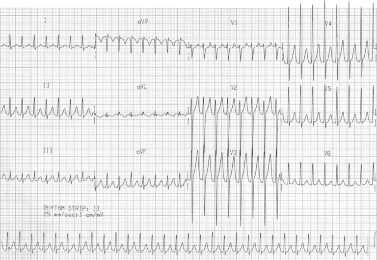 Atrioventricular Re-entry Tachycardia (AVRT) • LITFL • ECG Library ...