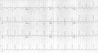 Atrioventricular Re-entry Tachycardia (AVRT) • LITFL • ECG Library ...