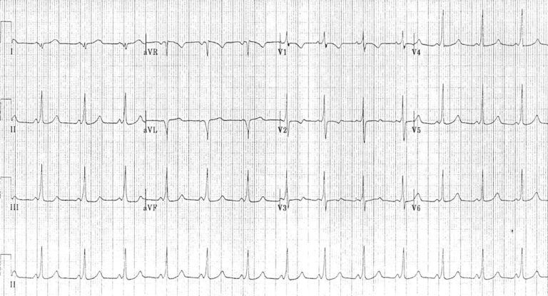 Atrioventricular Re-entry Tachycardia (AVRT) • LITFL • ECG Library ...