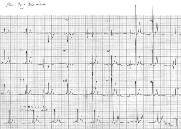 Atrioventricular Re-entry Tachycardia (AVRT) • LITFL • ECG Library ...