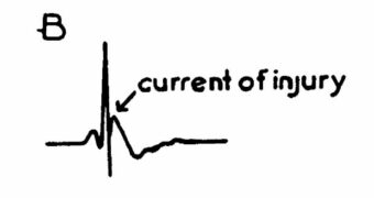 Osborn Wave (J Wave) • LITFL • ECG Library Basics