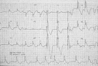 Osborn Wave (J Wave) • LITFL • ECG Library Basics