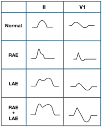 Biatrial Enlargement • LITFL • ECG Library Basics