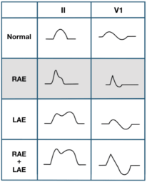 Right Atrial Enlargement • LITFL Medical Blog • ECG Library Basics