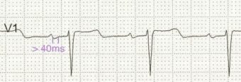 Left Atrial Enlargement • LITFL Medical Blog • ECG Library Basics