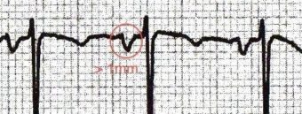 Left Atrial Enlargement • LITFL Medical Blog • ECG Library Basics