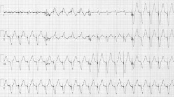 Pacemaker Malfunction • LITFL • ECG Library Diagnosis
