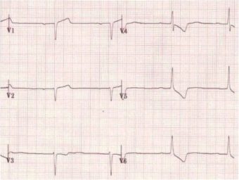 R wave • LITFL • ECG Library Basics