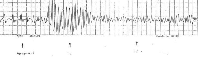 Ventricular Flutter • LITFL • ECG Library Diagnosis