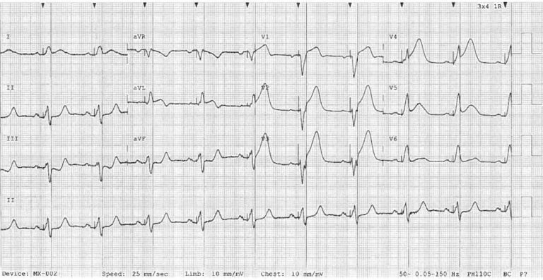 Sgarbossa Criteria • LITFL • ECG Library Diagnosis