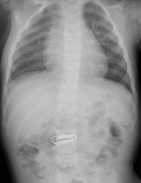 Top 10 X-Ray Foreign Bodies • LITFL • Arcanum veritas