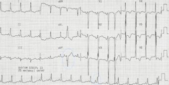 Premature Atrial Complex (PAC) • LITFL • ECG Library Diagnosis