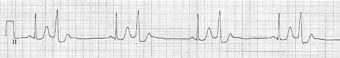 Premature Ventricular Complex (PVC) • LITFL • ECG Library Diagnosis