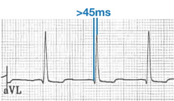 R Wave Peak Time RWPT • LITFL • ECG Library Diagnosis