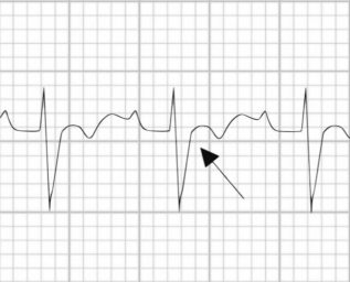 Epsilon Wave • LITFL Medical Blog • ECG Library Basics