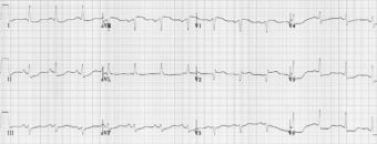 ST Elevation in aVR • LITFL • ECG Library Diagnosis