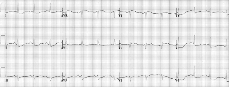 ST Elevation in aVR • LITFL • ECG Library Diagnosis