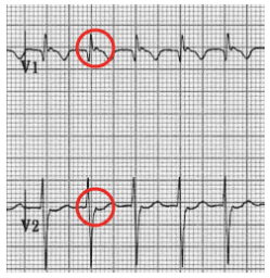 ECG Case 016 • LITFL • ECG Top 100 Self-Assessment Quiz