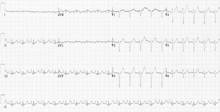 Low QRS Voltage • LITFL • ECG Library Diagnosis