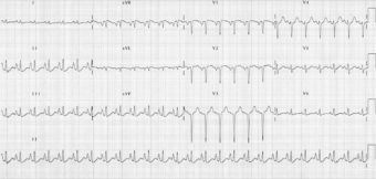 ECG in Chronic Obstructive Pulmonary Disease • LITFL • ECG Library